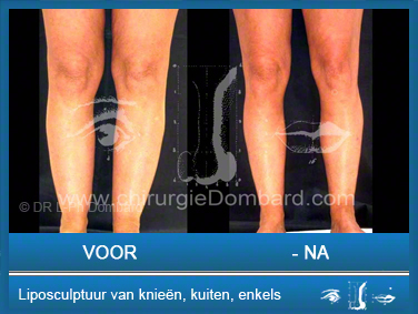 Dombard Kliniek Neuscorrectie: 19. Liposculptuur | liposuctie